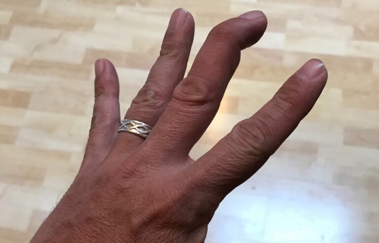 What Is Mallet Finger And How Do I Know If I Have It